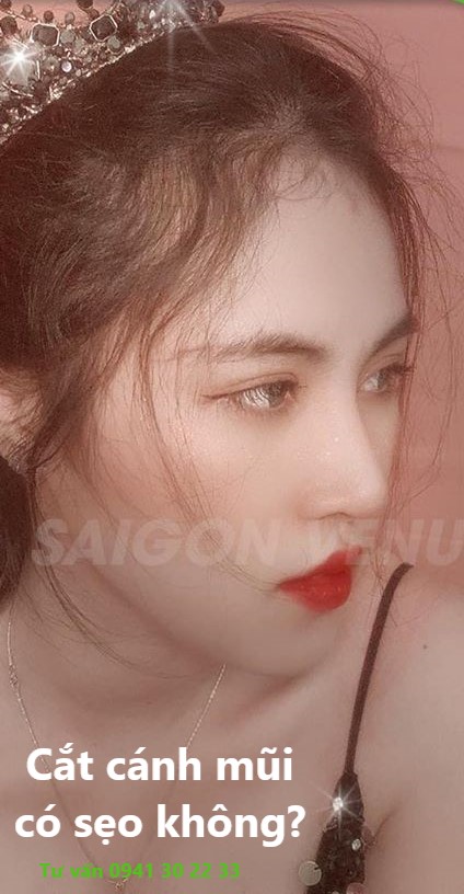 Cắt cánh mũi có để lại sẹo không? - Thẩm Mỹ Viện Sài Gòn Venus - Bác Sĩ Huy